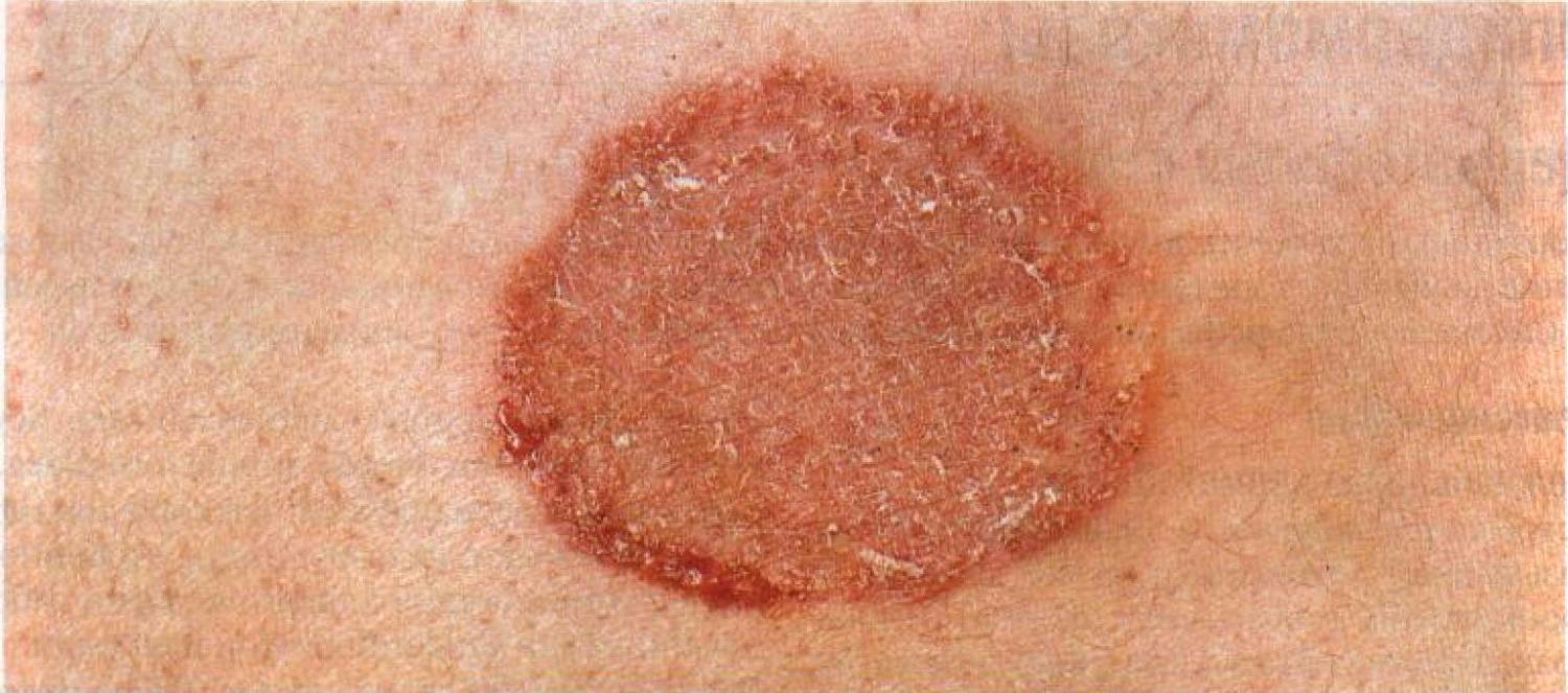 Виды и причины микоза, диагностика и методы лечения